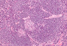 Sylvant (siltuximab) dosing, indications, interactions, adverse effects ...