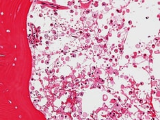 Cerdelga (eliglustat) dosing, indications, interactions, adverse ...