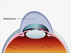 Photrexa, Epioxa (riboflavin 5'phosphate ophthalmic) dosing ...