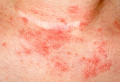 Cosentyx (secukinumab) dosing, indications, interactions, adverse ...