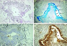 Pulmozyme (dornase alfa) dosing, indications, interactions, adverse ...