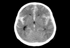 Lumbar Puncture (LP) Interpretation of Cerebrospinal Fluid ...