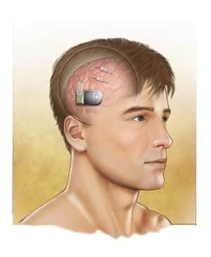 Neurostimulator Reduces Partial-Onset Seizures