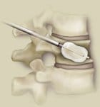 Kyphoplasty