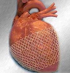 Heartnet Trial Halted Prematurely