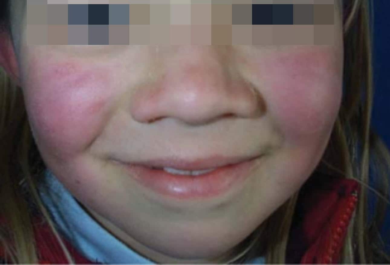 10 Erythema Conditions You Should Know