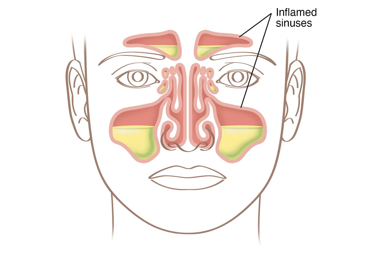 Migraine vs Sinus Headache: Making the Diagnosis