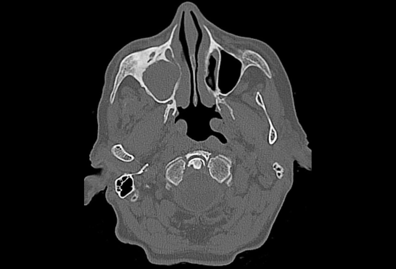 Migraine vs Sinus Headache: Making the Diagnosis