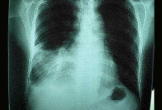 Chest Pain: Cardiac and Noncardiac Causes