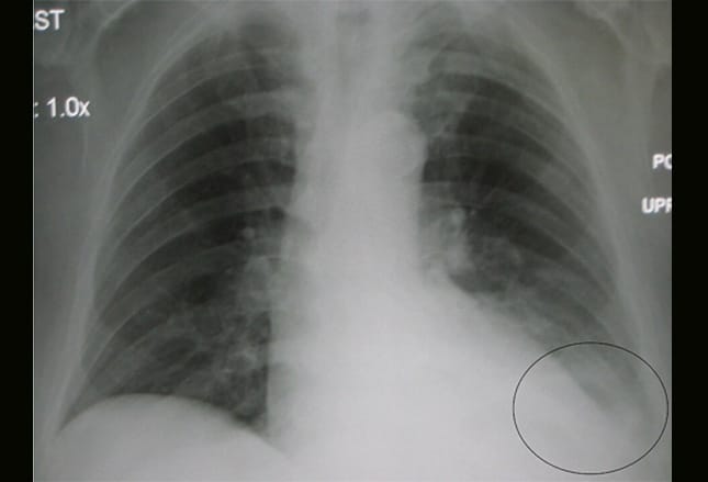 Chest Pain: Cardiac and Noncardiac Causes