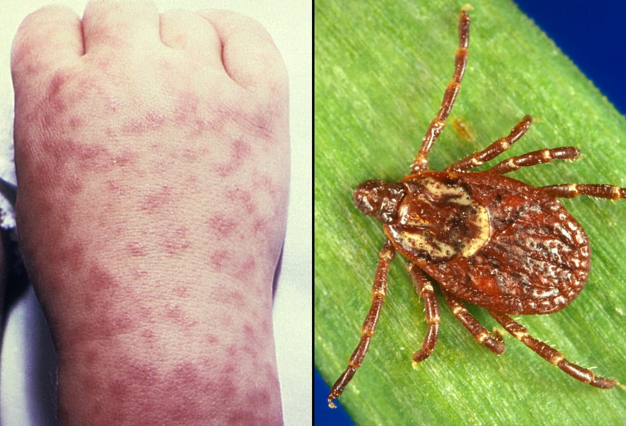 Community-Acquired Infections: A Clinical Refresher to Diagnose, Treat ...