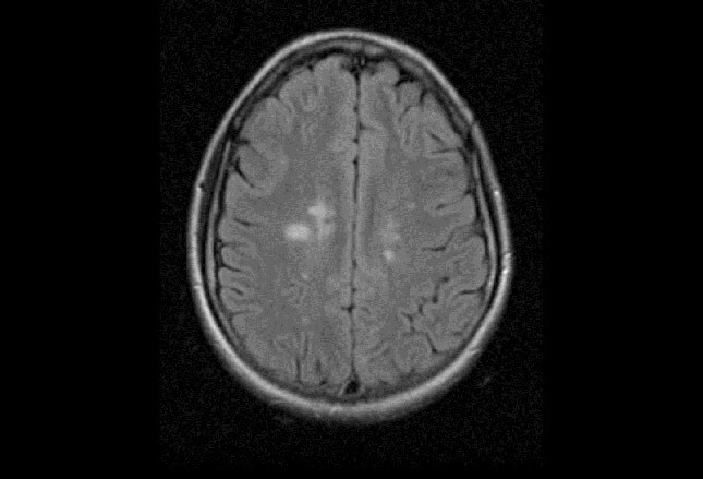 Multiple Sclerosis: Making the Diagnosis With MRI
