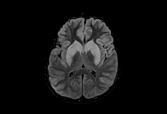 Multiple Sclerosis: Making the Diagnosis With MRI