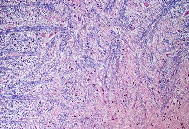 Multiple Sclerosis: Making the Diagnosis With MRI