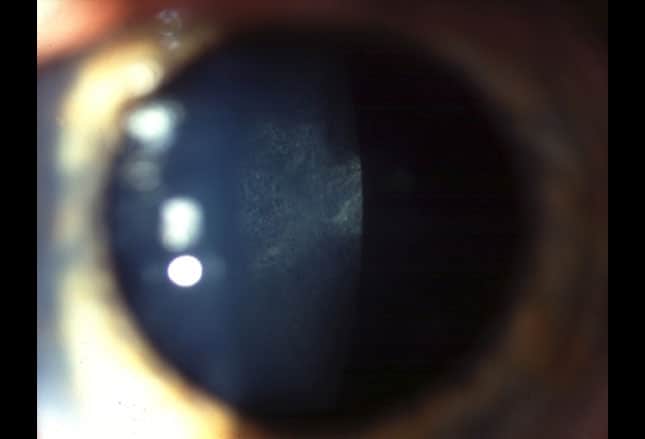 What the Eyes Tell You: 15 Abnormalities of the Lens