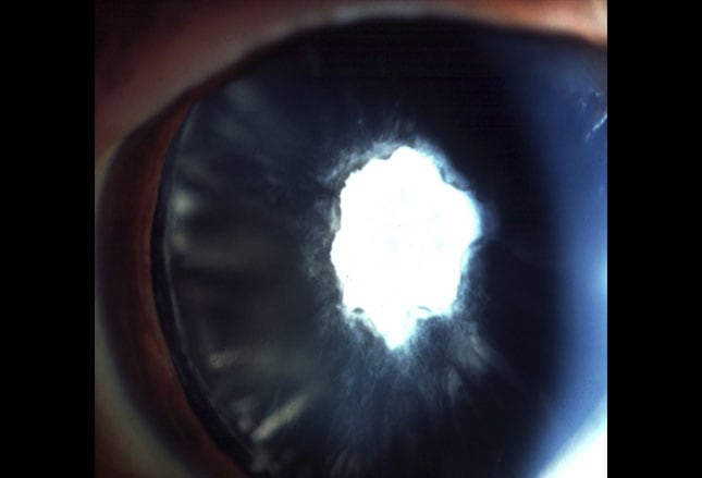 What the Eyes Tell You: 15 Abnormalities of the Lens