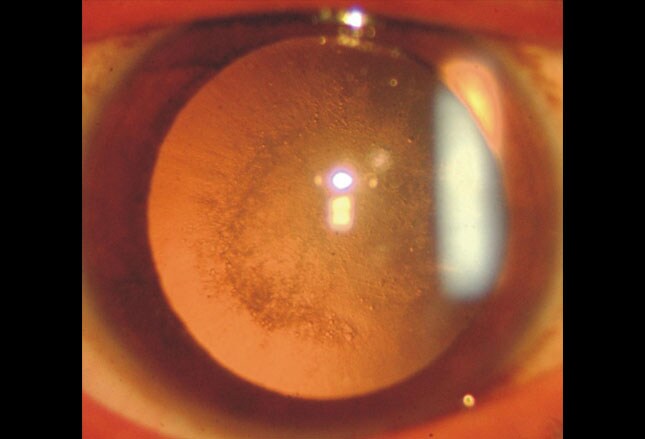 What the Eyes Tell You: 15 Abnormalities of the Lens