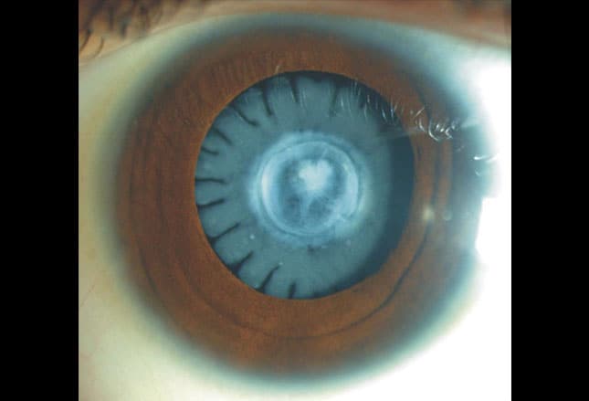 What the Eyes Tell You: 15 Abnormalities of the Lens