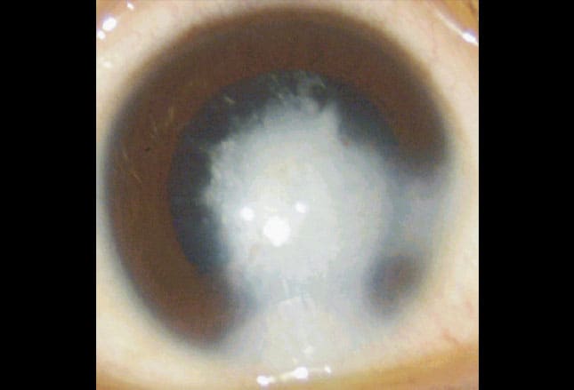 What the Eyes Tell You: 15 Abnormalities of the Lens