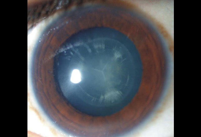 What the Eyes Tell You: 15 Abnormalities of the Lens