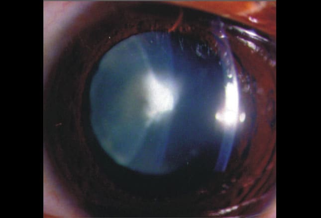 What the Eyes Tell You: 15 Abnormalities of the Lens