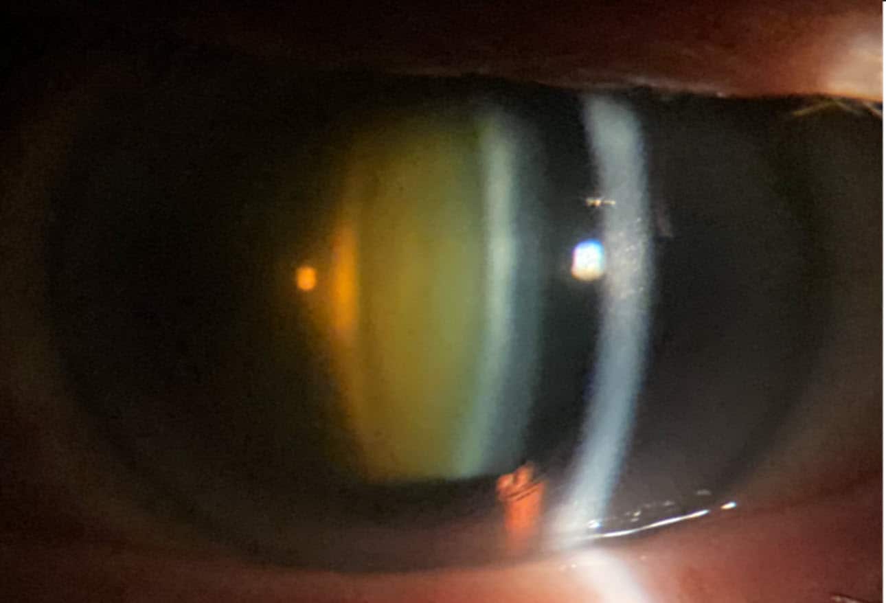 What the Eyes Tell You: 15 Abnormalities of the Lens