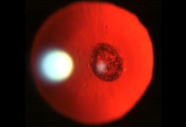 What the Eyes Tell You: 17 Abnormalities of the Lens