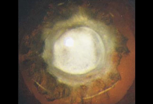 What the Eyes Tell You: 17 Abnormalities of the Lens