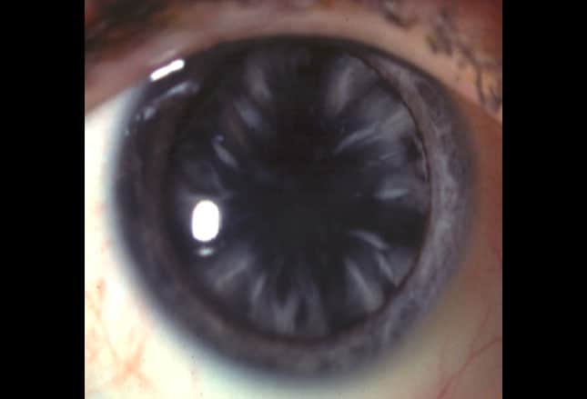 What the Eyes Tell You: 17 Abnormalities of the Lens