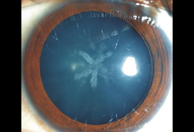 What the Eyes Tell You: 17 Abnormalities of the Lens