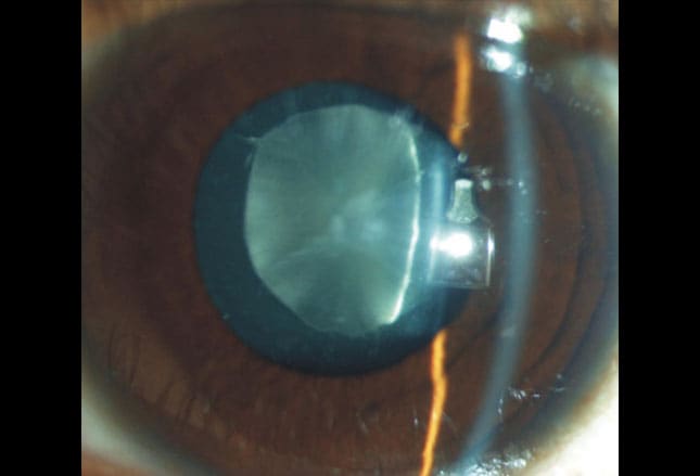 What the Eyes Tell You: 17 Abnormalities of the Lens