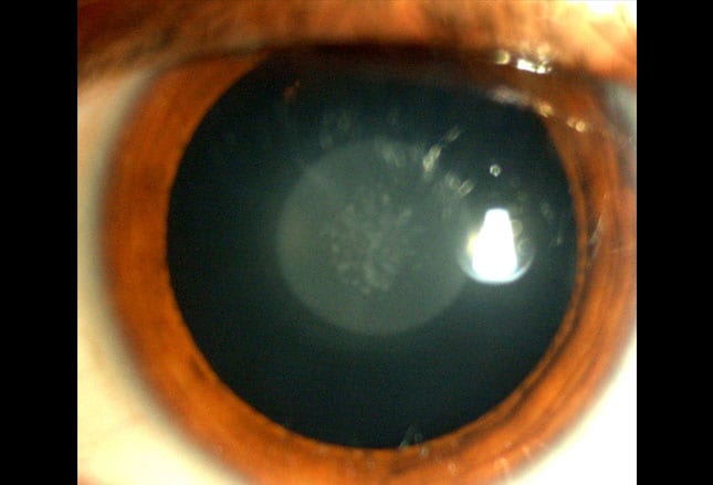 What the Eyes Tell You: 17 Abnormalities of the Lens