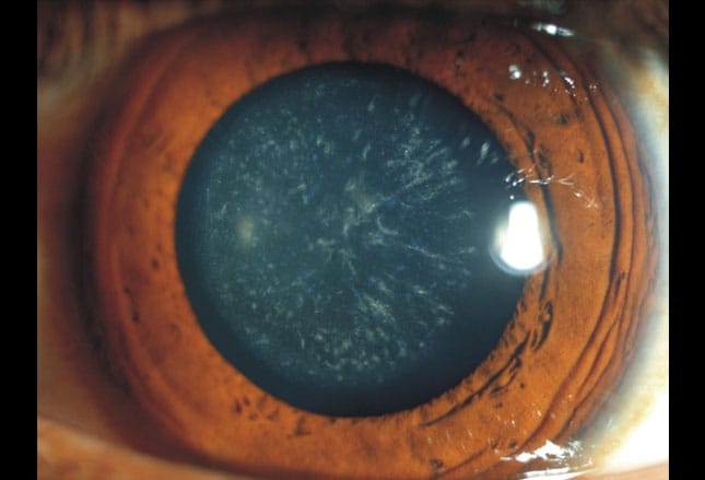 What the Eyes Tell You: 17 Abnormalities of the Lens