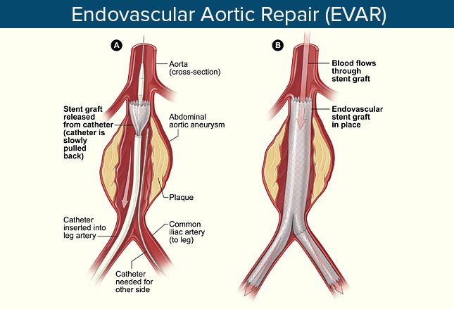 Abdominal Aortic Aneurysm: Has the Bubble Burst?
