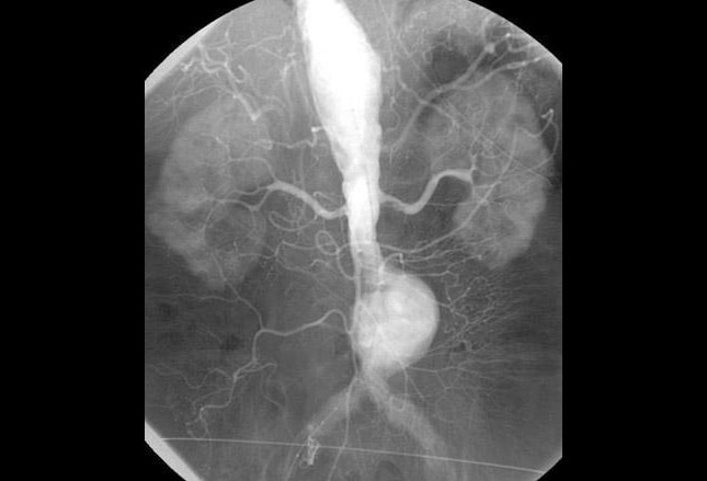 Abdominal Aortic Aneurysm: Has the Bubble Burst?