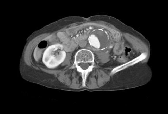 Abdominal Aortic Aneurysm: Has the Bubble Burst?