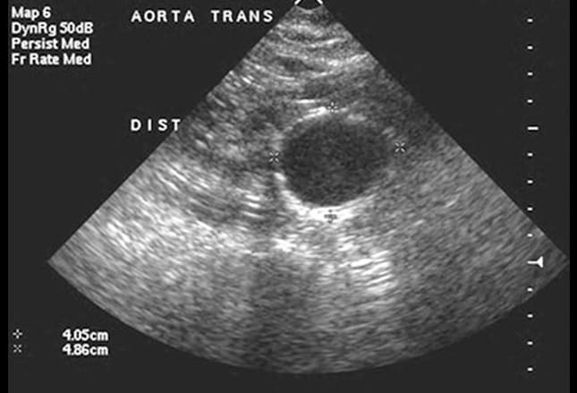 Abdominal Aortic Aneurysm: Has the Bubble Burst?