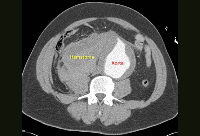 Abdominal Aortic Aneurysm: Has the Bubble Burst?
