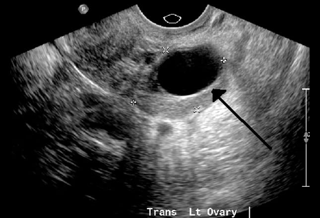 Ovarian Cyst Vs Ectopic Pregnancy