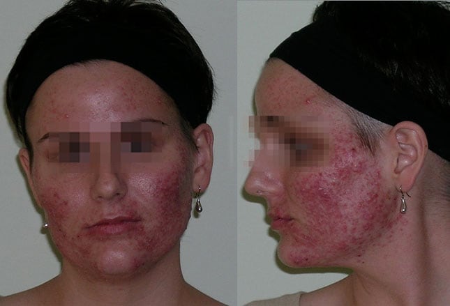 Acne: More Than Skin Deep