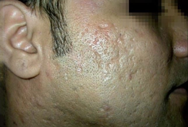 Acne: More Than Skin Deep