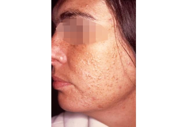 Acne: More Than Skin Deep