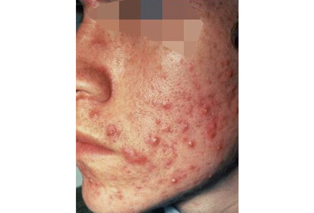 Acne: More Than Skin Deep