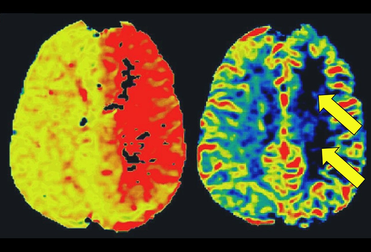 Acute Stroke: Critical Diagnostic Findings
