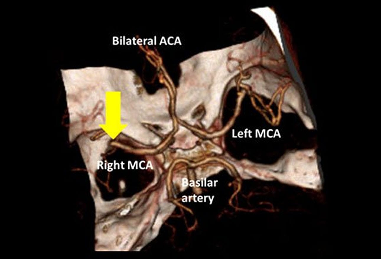 Acute Stroke: Critical Diagnostic Findings