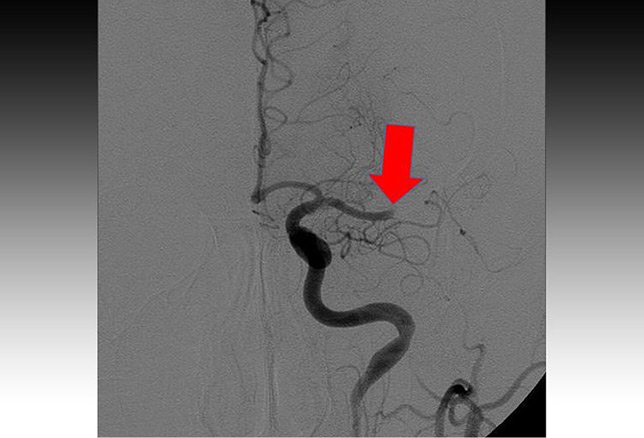Acute Stroke: Critical Diagnostic Findings