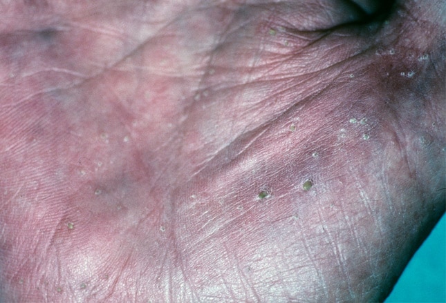 Poisoning Clues on the Skin: 10 Cases