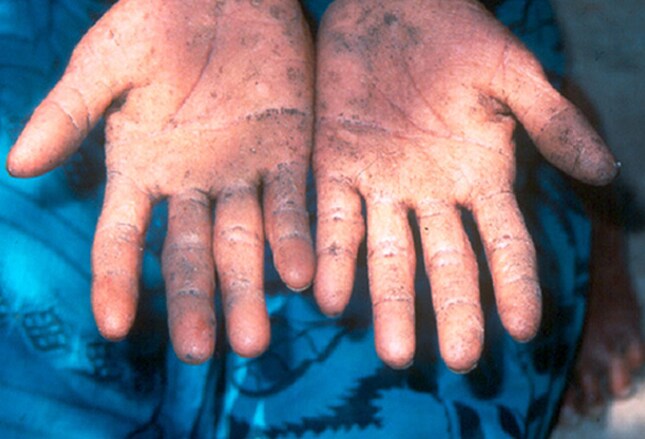 Poisoning Clues on the Skin: 10 Cases