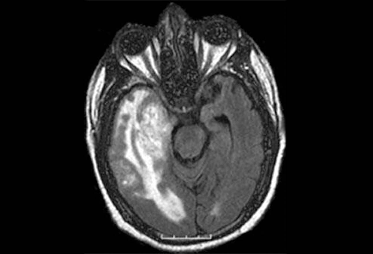 Adult Brain Tumors: A Spreading Problem