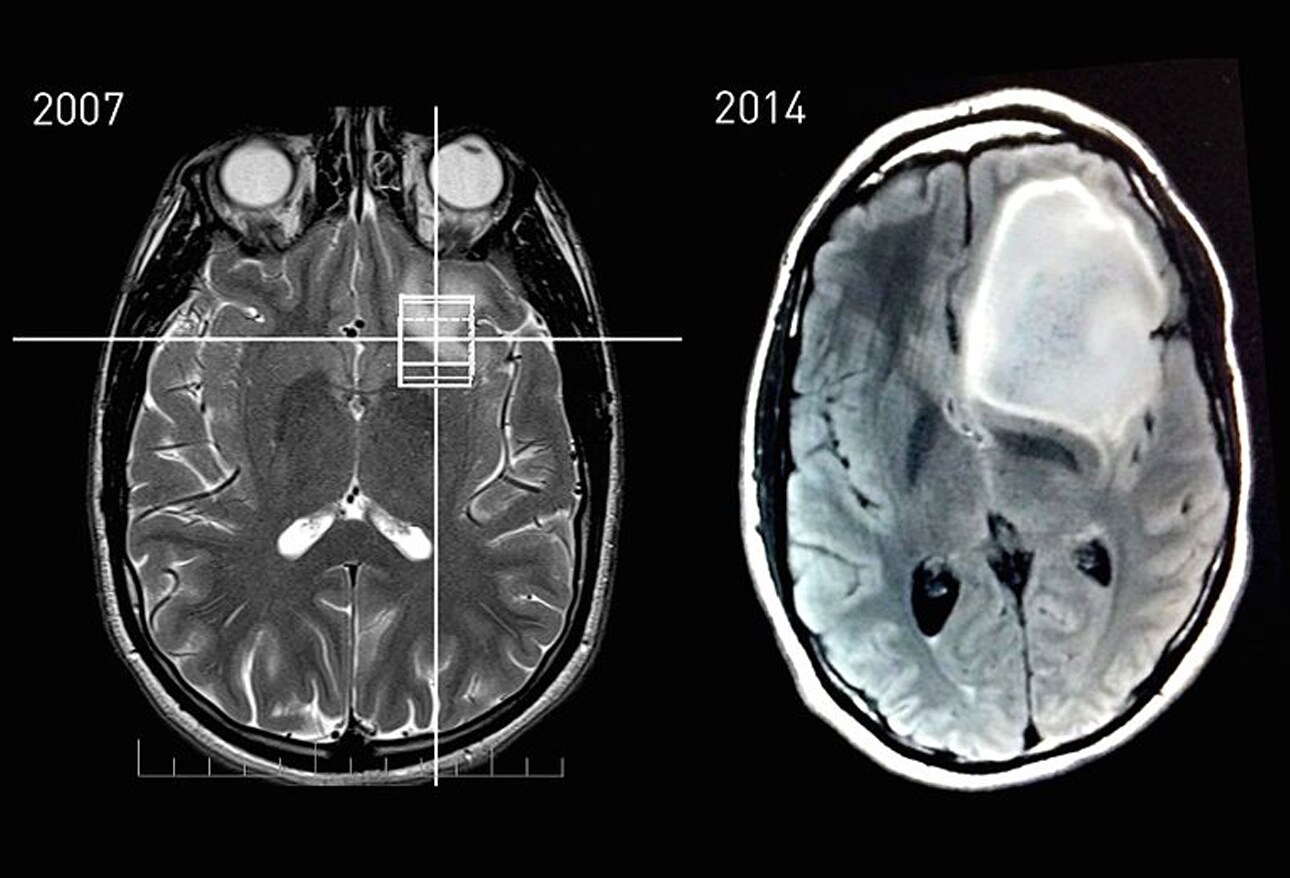 Adult Brain Tumors: A Spreading Problem